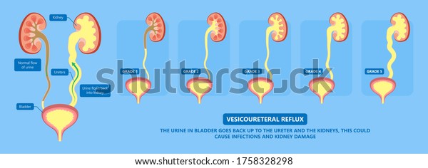 kidney damage UTI scan test tube VCUG acute VUR cyst exam flow pain ...