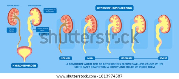 Kidney Damage Uti Scan Test Tube Stock Vector (Royalty Free) 1813974587 ...