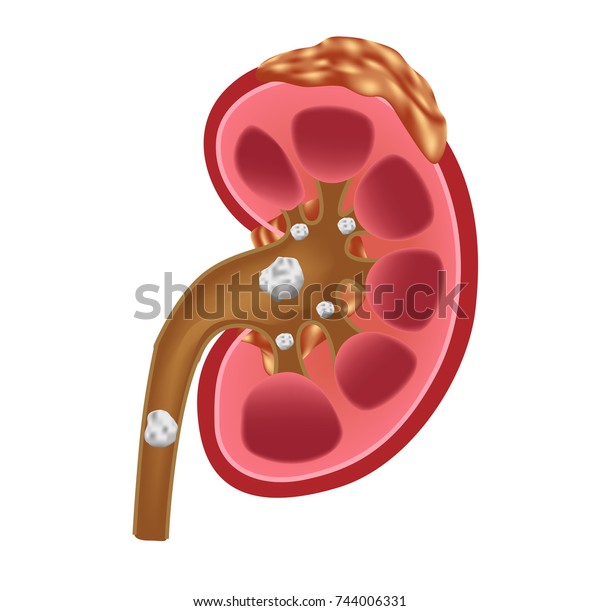 Kidney Stones Medical Concept Vector Anatomy Stock Vector (Royalty Free ...