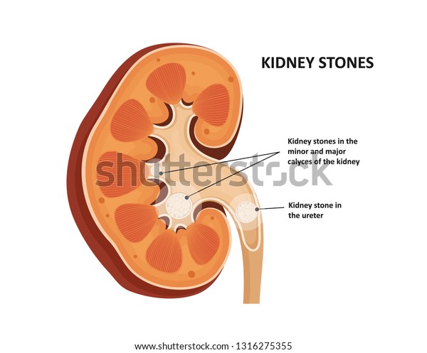 Kidney Stones Vector Illustration Stock Vector (Royalty Free ...