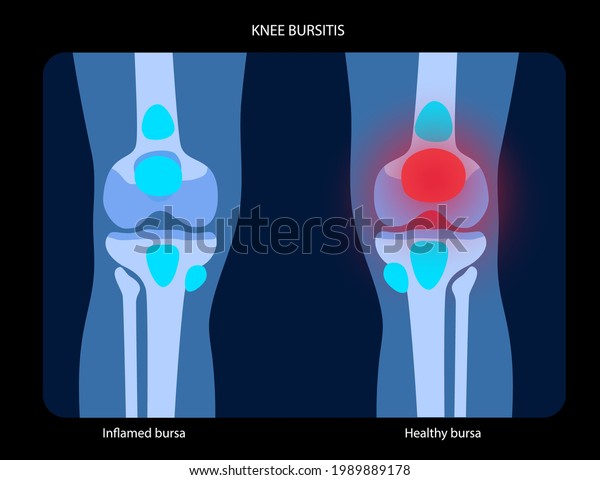 Inflamación por bursitis de rodilla. Bursa inflamada en la pierna ...