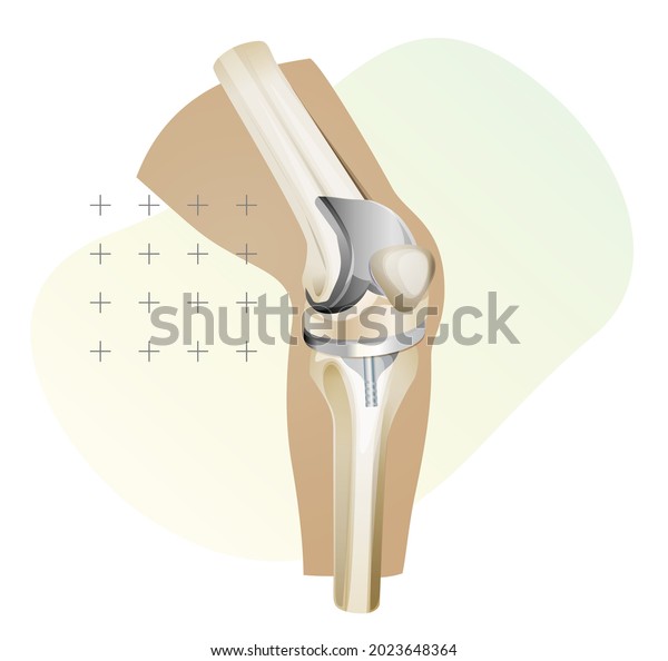 Knee Joint Replacement Surgery Illustration Eps Stock Vector (Royalty ...