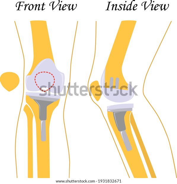 Knee replacement. Joint prosthetics. Knee endoprosthesis. Vector ...