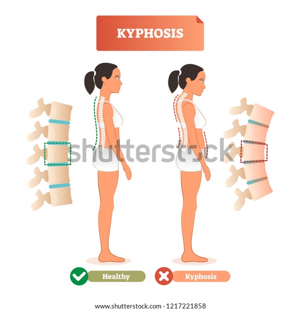 Kyphosis Vector Illustration Back Defect Diagnosis Stock Vector ...