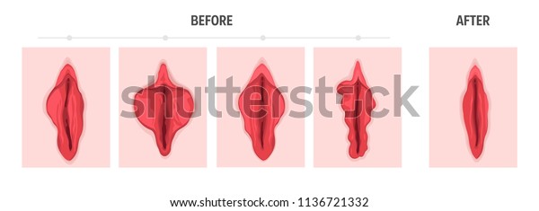 Labiaplasty Vaginoplasty Types Female Labia Stock Vector