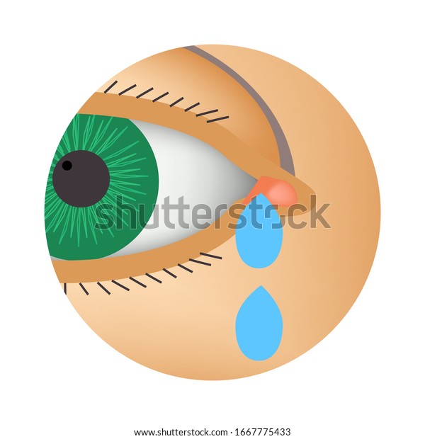 Lacrimation Eyes Symptom Conjunctivitis Allergies Inflammation Stock ...