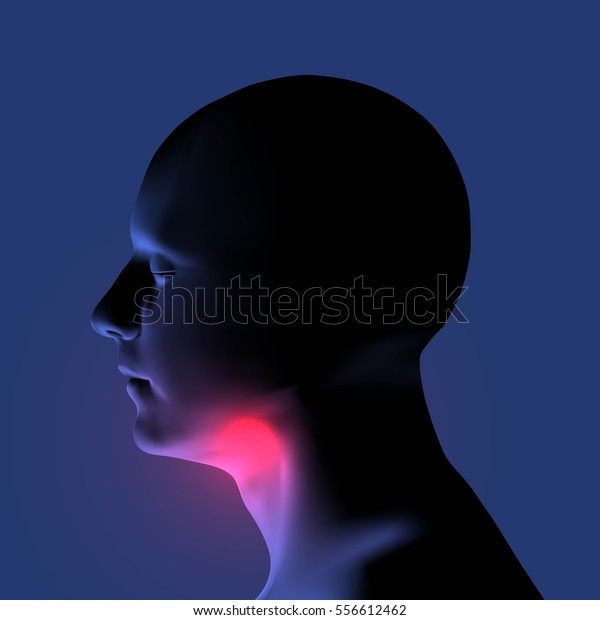 Laryngitis Vector Illustration Human Throat Irritation Stock Vector ...