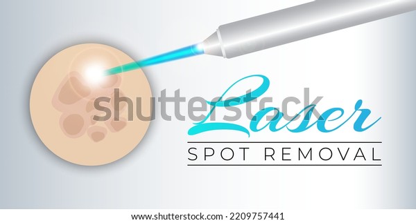 Laser Spot Removal Background Illustration Stock Vector (Royalty Free ...