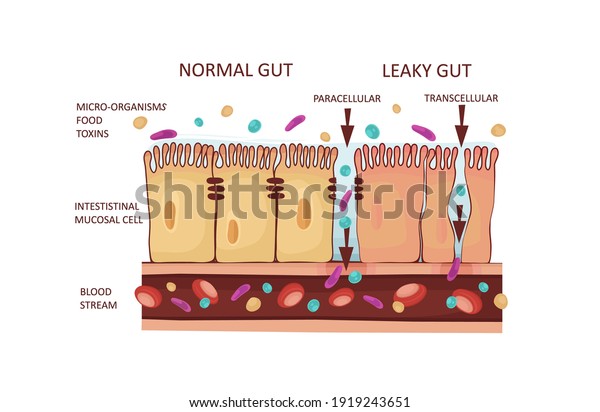 Leaky Gut Syndrome or Intestinal Permeability Diagram. Autoimmune ...