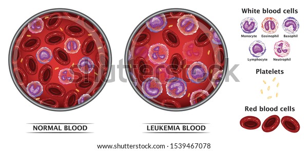 Leukemia Blood Cells Normal Blood Cells Stock Vector (Royalty Free ...