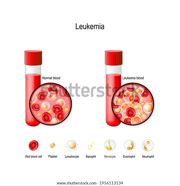 Leukemia Red White Blood Cell Test Stock Vector (Royalty Free ...