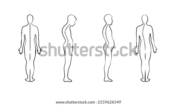 Vektor Stok Line Drawing Human Vertebral Deformities Types (Tanpa ...