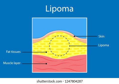 Lipoma Images, Stock Photos & Vectors | Shutterstock
