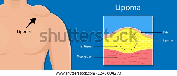 Lipoma disease tissue fatty grows body skin soft hurt pain madelung ...
