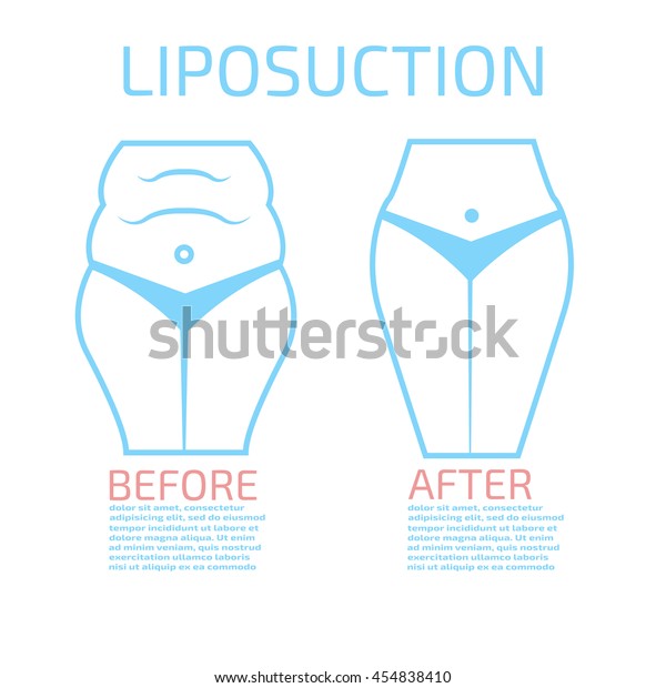 Liposuction Before After Info Graphics: vector de stock (libre de ...