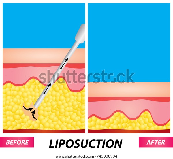 Liposuction , fat surgery diagram before and after vector illustration