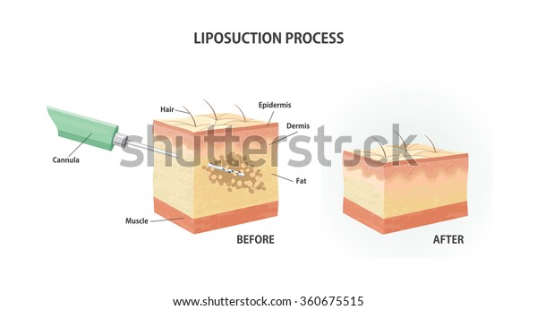 Liposucción. Liposucción asistida por succión. Ilustración del vector