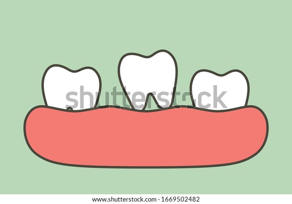 Loose Tooth Tooth Fall Out Gum Stock Vector (Royalty Free) 1669502482 ...