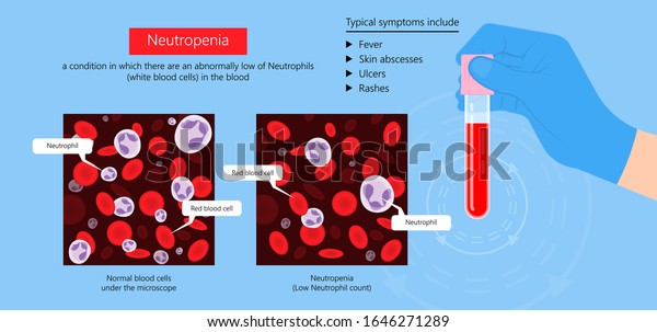 Low White Blood Cell Count Leukopenia Stock Vector (Royalty Free ...