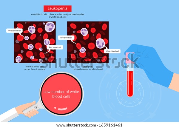 Low White Blood Cell Count Leukopenia Stock Vector (Royalty Free ...