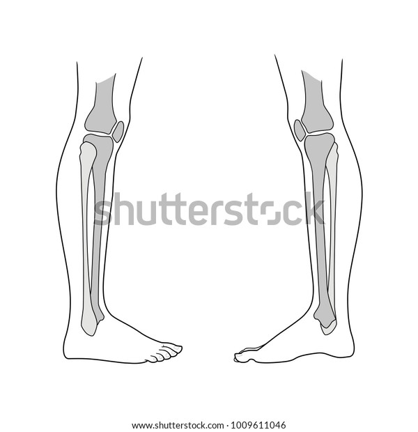 Lower Limb Person Including Knee Type Stock Vector (Royalty Free ...