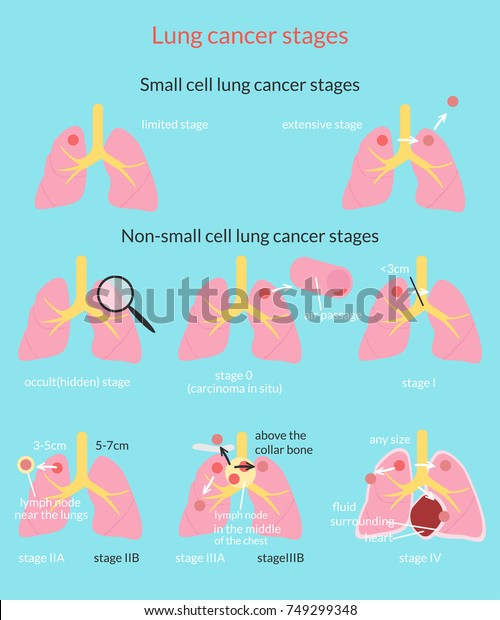 Lung Cancer Stages Stage 0 Through Stock Vector (Royalty Free) 749299348
