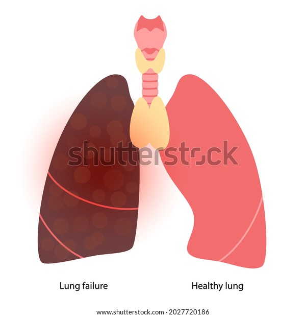 3.582 Lung Failure Bilder, Stockfotos und Vektorgrafiken | Shutterstock