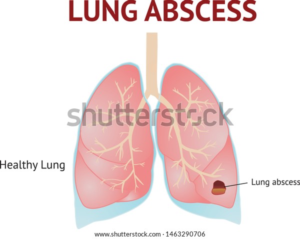 Lungs Abscess Lungs Disease Isolated Vector Stock Vector (Royalty Free ...