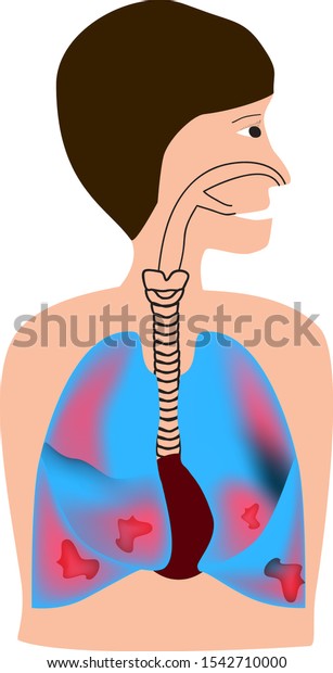 Lungs Affected By Tuberculosis Bronchitis Human Stock Vector (Royalty ...
