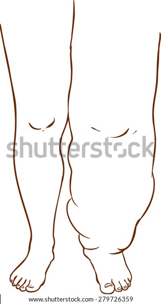 Lymphedema Disease Stock Vector (Royalty Free) 279726359 | Shutterstock