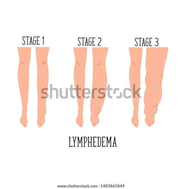 Vektor Stok Lymphedema Stages Lymphatic System Disfunction ...