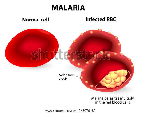 Malaria. Normal and infected red blood cells. Malaria is a disease ...