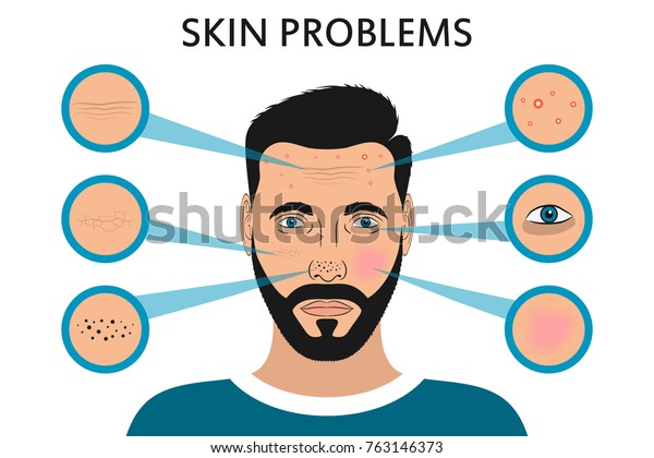 Male Face Skin Problems Acne Pimples Stock Vector (Royalty Free ...