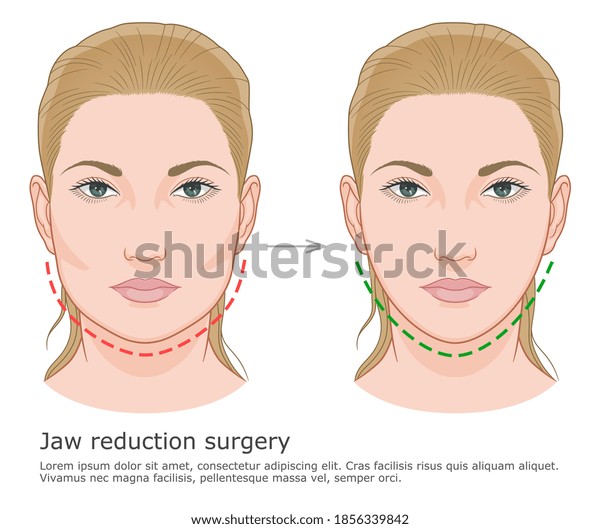 "Jaw reduction surgery" - 118 Ảnh, vector và hình chụp có sẵn ...