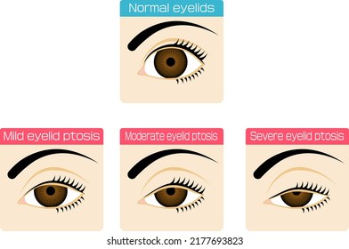 Material That Illustrates Symptoms Ptosis Stock Vector (Royalty Free ...