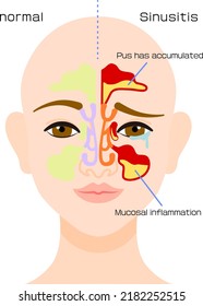 Material That Illustrates Symptoms Sinusitis Stock Vector (Royalty Free ...