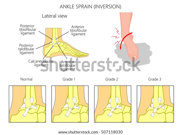 Mechanism Formation Ankle Sprain Grades Ankle Stock Vector (Royalty ...