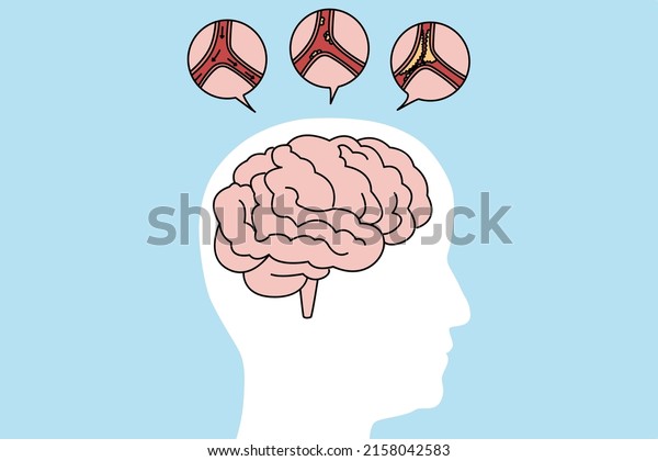 Ilustración médica de la apoplejía cerebral: vector de stock (libre de ...