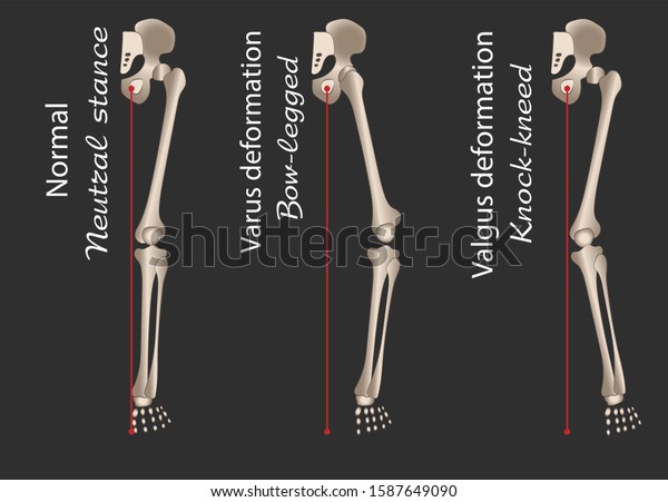 Medical Poster Normal Legs Varus Valgus Stock Vector (Royalty Free ...