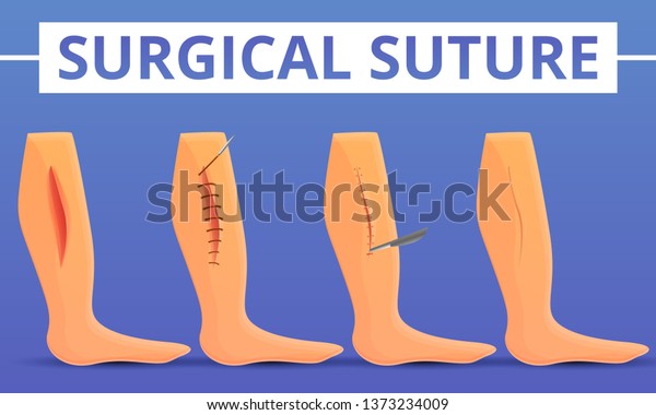 Medical Suture Concept Background Cartoon Illustration Stock Vector ...