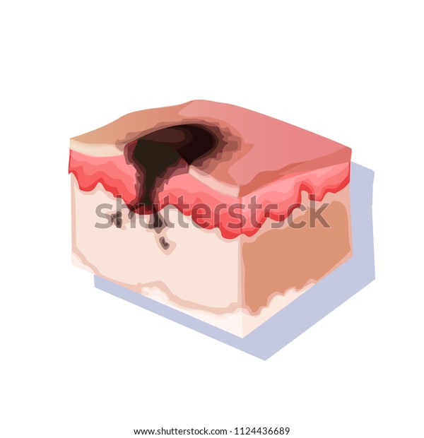 Melanocytic nevus. junctional, compound and intradermal nevus ...