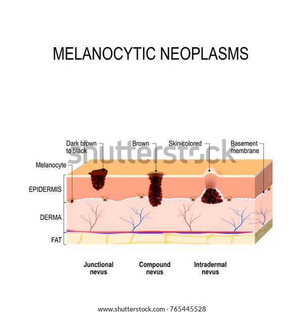 Melanocytic Nevus Junctional Compound Intradermal Nevus Stock Vector ...