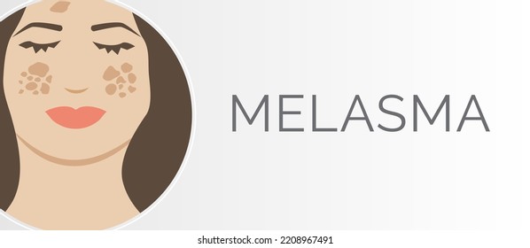 95 Melasma Face Stock Vectors, Images & Vector Art | Shutterstock