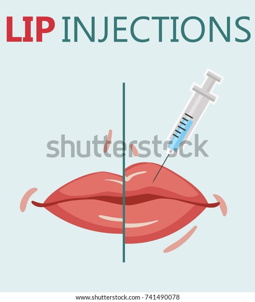 Modern Vector Illustration Lips Injections Lip Stock Vector (Royalty ...