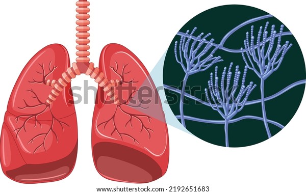 Mold Spores Grow Human Lungs Illustration Stock Vector (Royalty Free ...