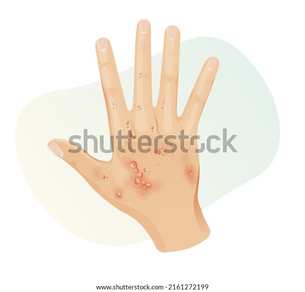 Monkeypox Skin Rashes Spots Symptoms Icon स्टॉक वेक्टर (रॉयल्टी फ़्री ...