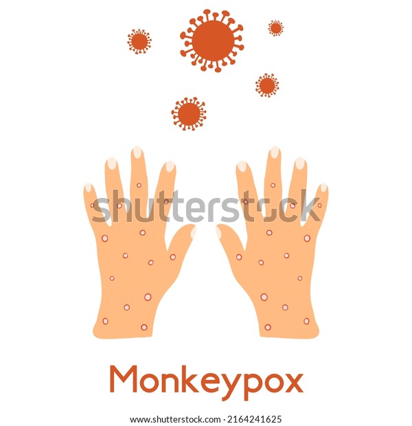 Monkeypox Symptoms Hand Skin Rashes Blisters 库存矢量图（免版税）2164241625 ...