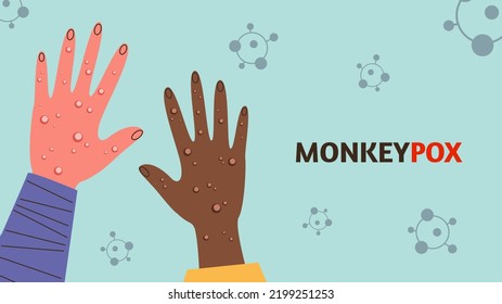 Monkeypox Virus Human Hands Papules Vector Stock Vector (Royalty Free ...