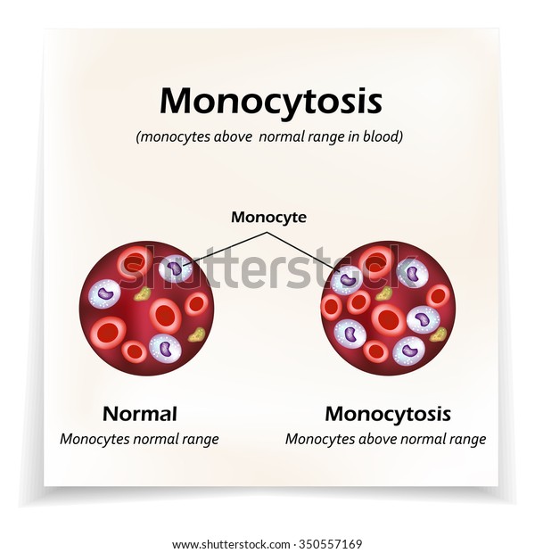 Monocytes Above Normal Range Blood Monocytosis 스톡 벡터(로열티 프리) 350557169