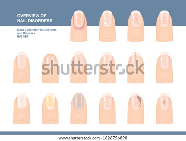 Most Common Nail Disorders Diseases Big Stock Vector (Royalty Free ...